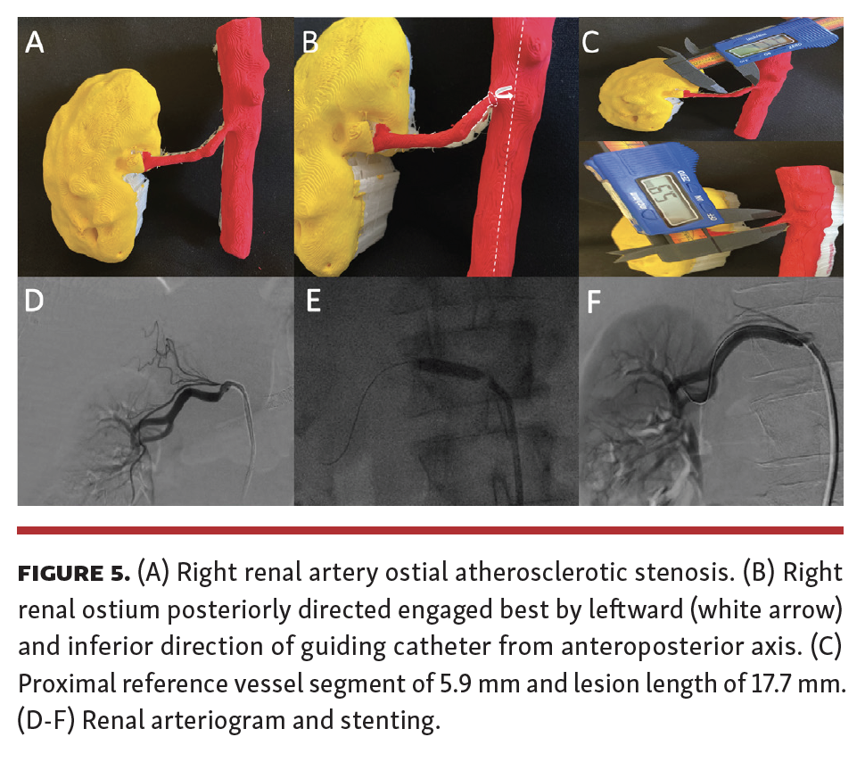 Renal Artery Stent